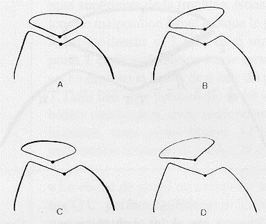 Syndrome rotulien ou fémoro-patellaire et rééducation