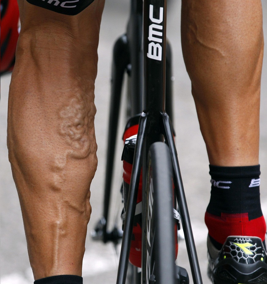 Varices et sport | Pratiques Sportives | IRBMS