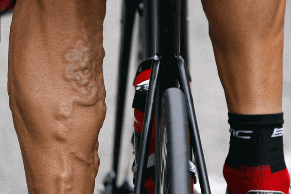 Varices et sport : facteurs de risque, complications et traitements