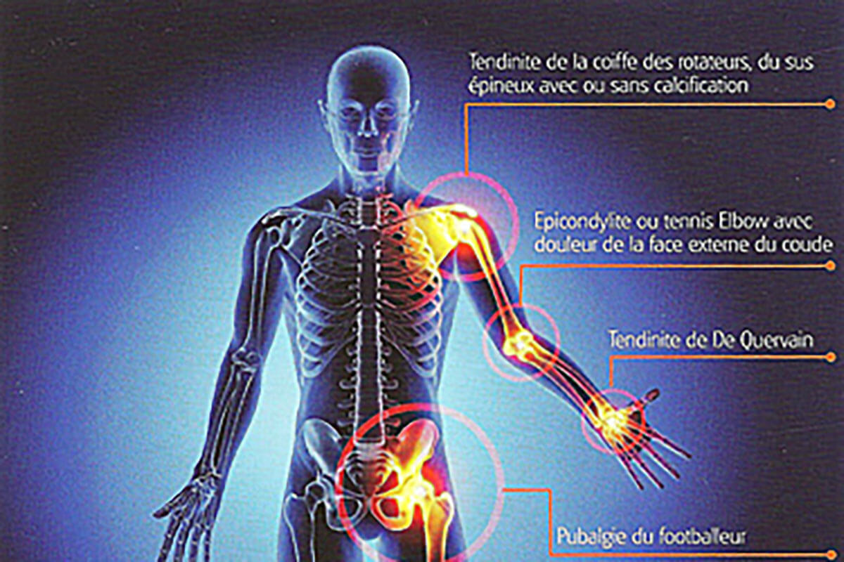 Tendinites : 16 diagnostics fréquents observés en médecine du sport