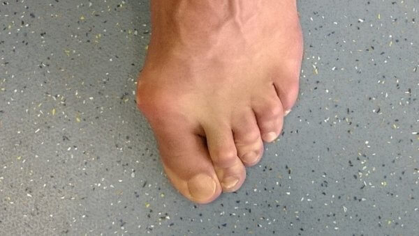 Gros orteil (lésion de l’hallux) | IRBMS